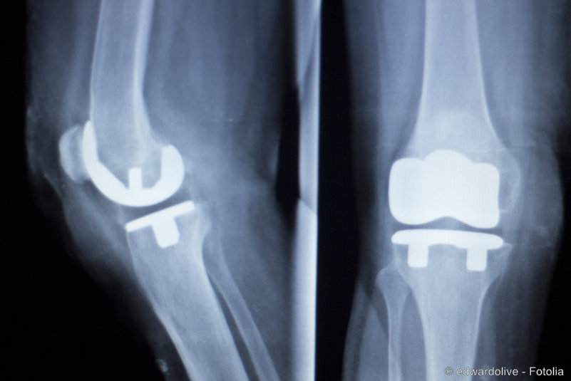 Gonarthrose: Ursachen, Symptome, Medikamente, OP - NetDoktor.de
