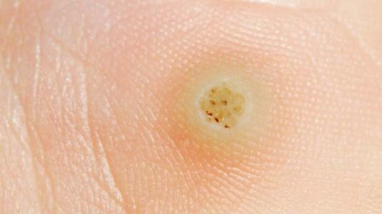 Warzen: Ursachen, Arten und Vorbeugung - NetDoktor.de