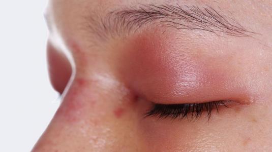 Phlegmone: Ursachen, Symptome, Therapie - NetDoktor.de