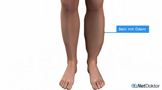 Ödem (Wassereinlagerungen): Ursachen, Formen, Therapie - NetDoktor.de
